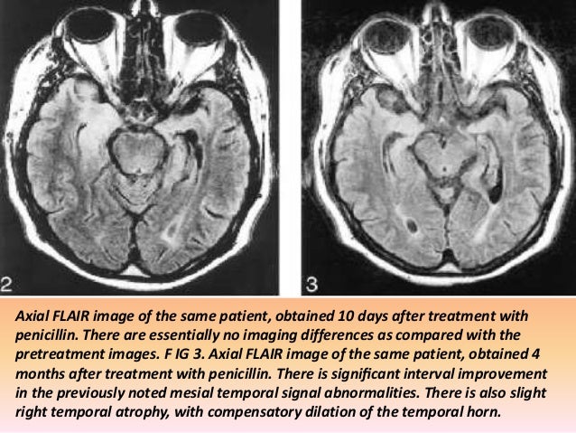 Presentation1.pptx, radiological imaging of syphilis.