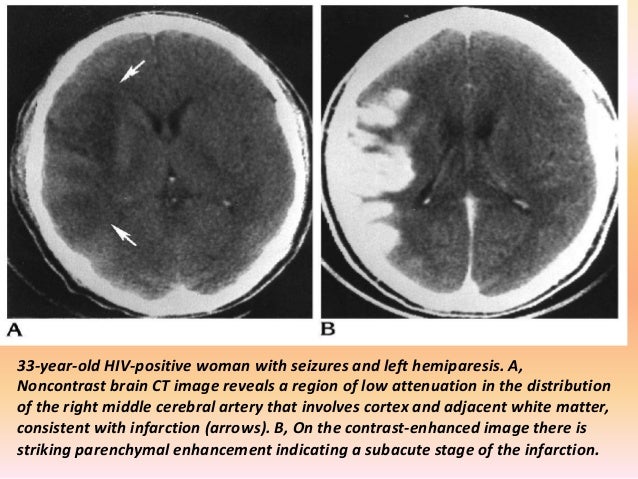 Presentation1.pptx, radiological imaging of syphilis.