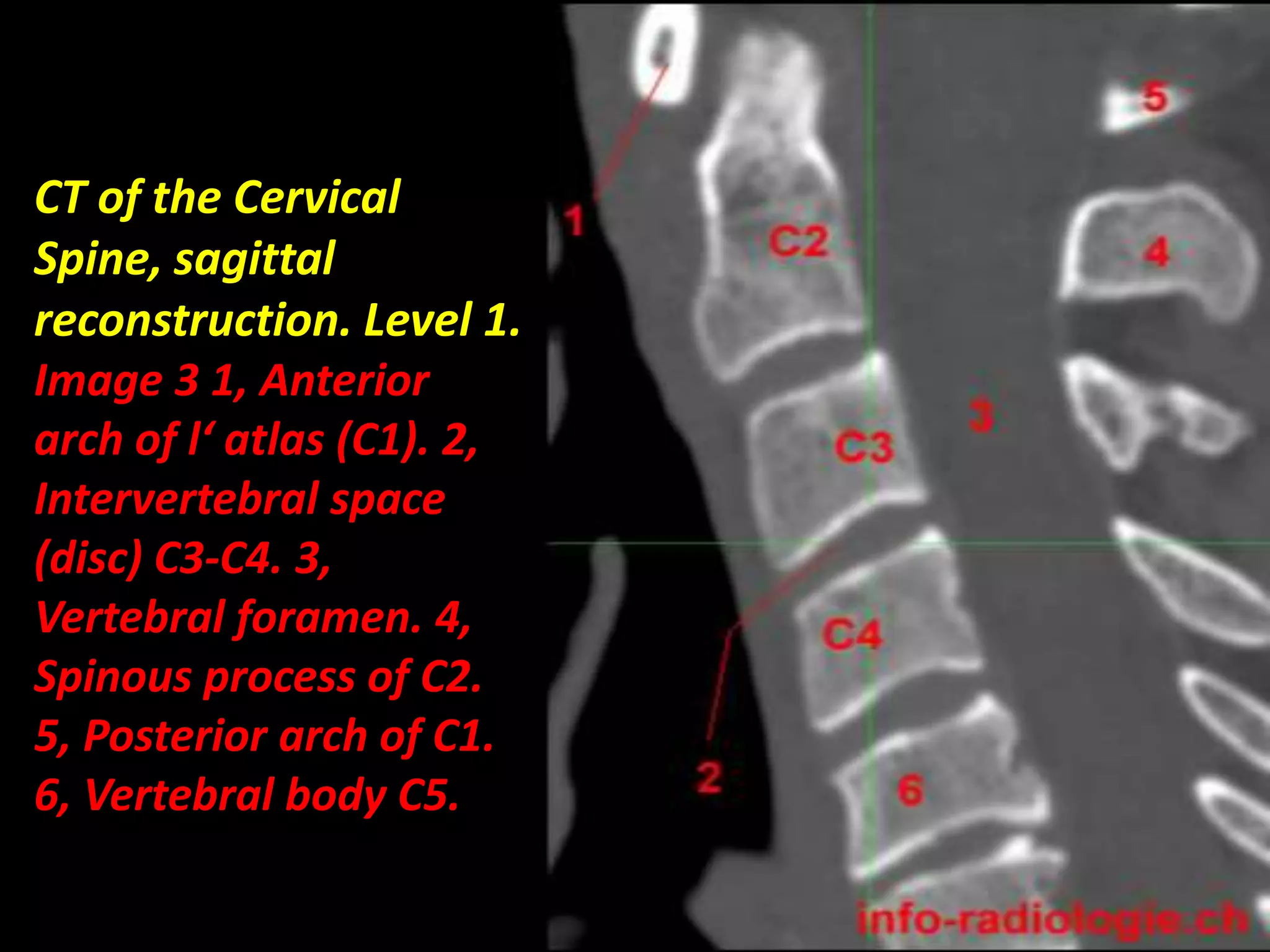 Presentation1.pptx, normal spinal anatomy. | PPTX | Death, Injury, or ...