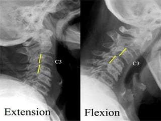 Presentation1.pptx, normal spinal anatomy. | PPTX