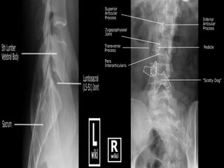 Presentation1.pptx, normal spinal anatomy. | PPTX