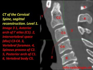 Presentation1.pptx, normal spinal anatomy. | PPTX | Death, Injury, or ...