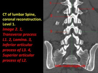 Presentation1.pptx, normal spinal anatomy. | PPTX