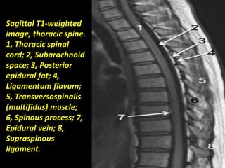 Presentation1.pptx, normal spinal anatomy. | PPTX