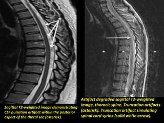 Presentation1.pptx, normal spinal anatomy. | PPTX