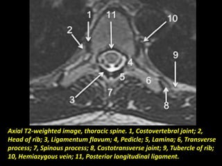 Presentation1.pptx, normal spinal anatomy. | PPTX