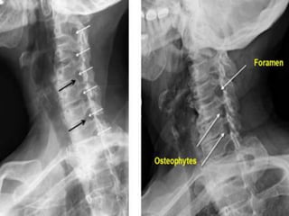 Presentation1.pptx, normal spinal anatomy. | PPTX