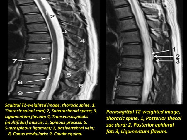 Presentation1.pptx, normal spinal anatomy. | PPT
