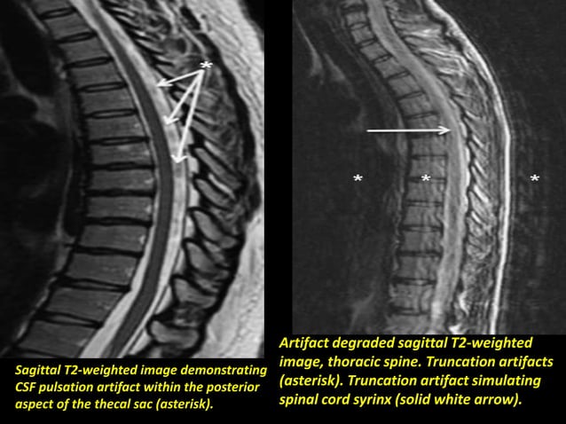Presentation1.pptx, normal spinal anatomy. | PPT