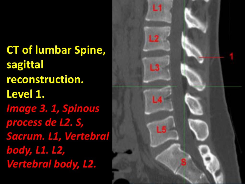 Presentation1.pptx, normal spinal anatomy.
