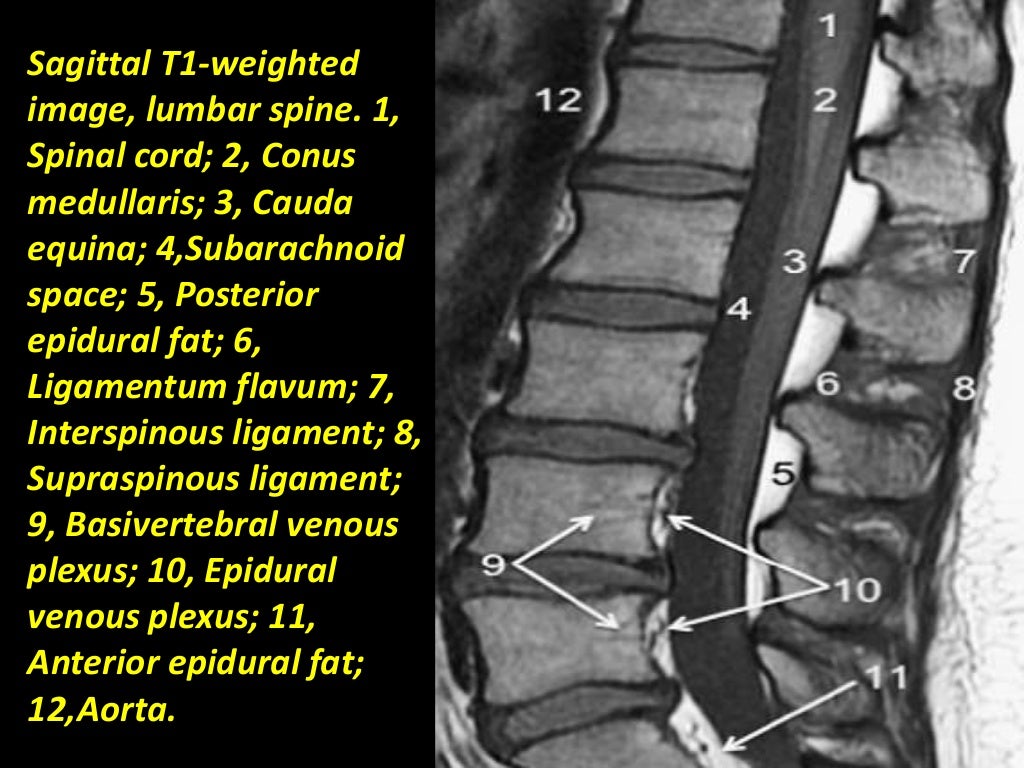 Presentation1.pptx, normal spinal anatomy.
