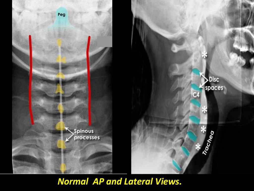 Presentation1.pptx, normal spinal anatomy.