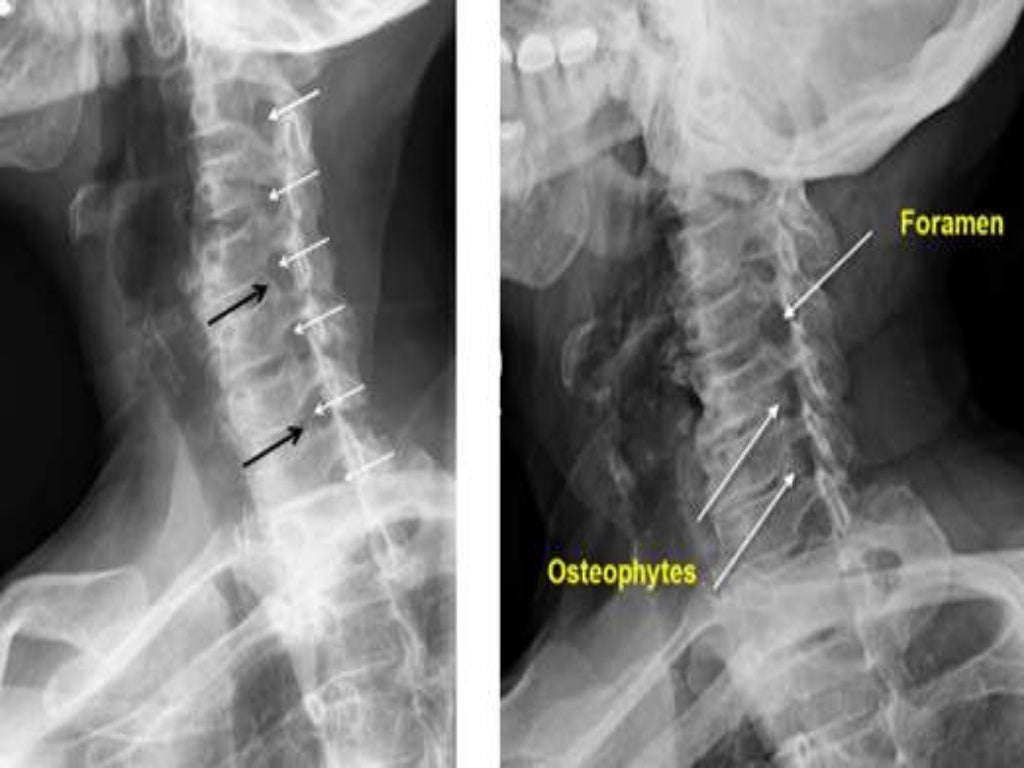 Presentation1.pptx, normal spinal anatomy.