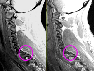 Presentation1.pptx, radiological imaging of spinal trauma and spinal ...