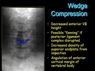 Presentation1.pptx, radiological imaging of spinal trauma and spinal ...