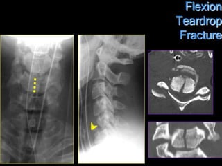 Presentation1.pptx, radiological imaging of spinal trauma and spinal ...
