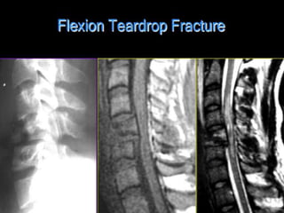 Presentation1.pptx, radiological imaging of spinal trauma and spinal ...