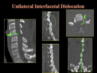 Presentation1.pptx, radiological imaging of spinal trauma and spinal ...
