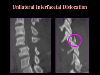 Presentation1.pptx, radiological imaging of spinal trauma and spinal ...