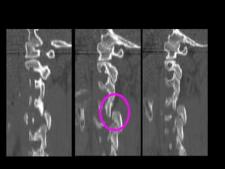 Presentation1.pptx, radiological imaging of spinal trauma and spinal ...