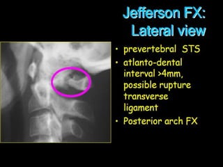Presentation1.pptx, radiological imaging of spinal trauma and spinal ...