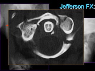 Presentation1.pptx, radiological imaging of spinal trauma and spinal ...