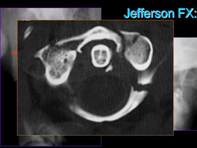 Presentation1.pptx, radiological imaging of spinal trauma and spinal ...