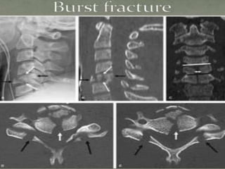 Presentation1.pptx, radiological imaging of spinal trauma and spinal ...