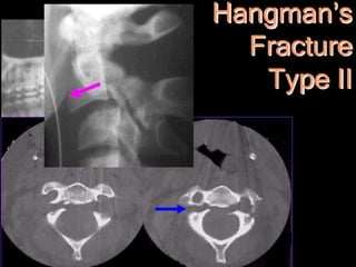 Presentation1.pptx, radiological imaging of spinal trauma and spinal ...
