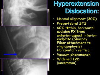 Presentation1.pptx, radiological imaging of spinal trauma and spinal ...