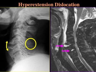 Presentation1.pptx, radiological imaging of spinal trauma and spinal ...