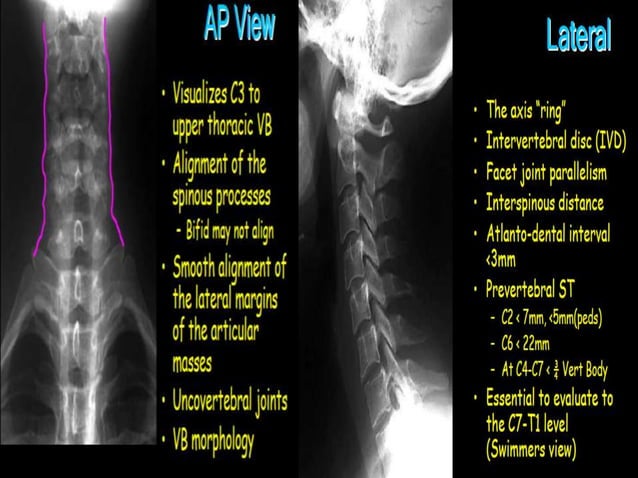 Presentation1.pptx, radiological imaging of spinal trauma and spinal ...