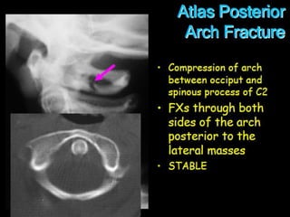 Presentation1.pptx, radiological imaging of spinal trauma and spinal ...