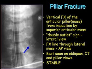 Presentation1.pptx, radiological imaging of spinal trauma and spinal ...