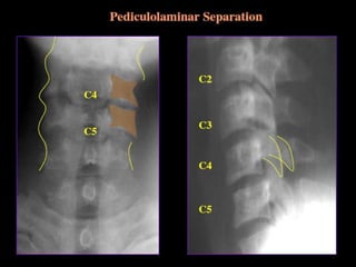 Presentation1.pptx, radiological imaging of spinal trauma and spinal ...