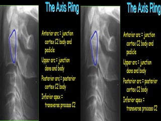 Presentation1.pptx, radiological imaging of spinal trauma and spinal ...