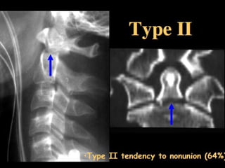 Presentation1.pptx, radiological imaging of spinal trauma and spinal ...