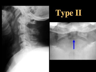 Presentation1.pptx, radiological imaging of spinal trauma and spinal ...