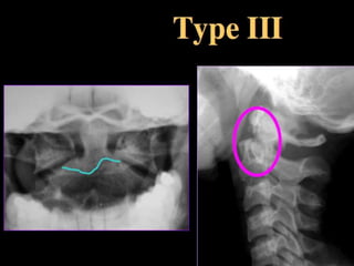 Presentation1.pptx, radiological imaging of spinal trauma and spinal ...