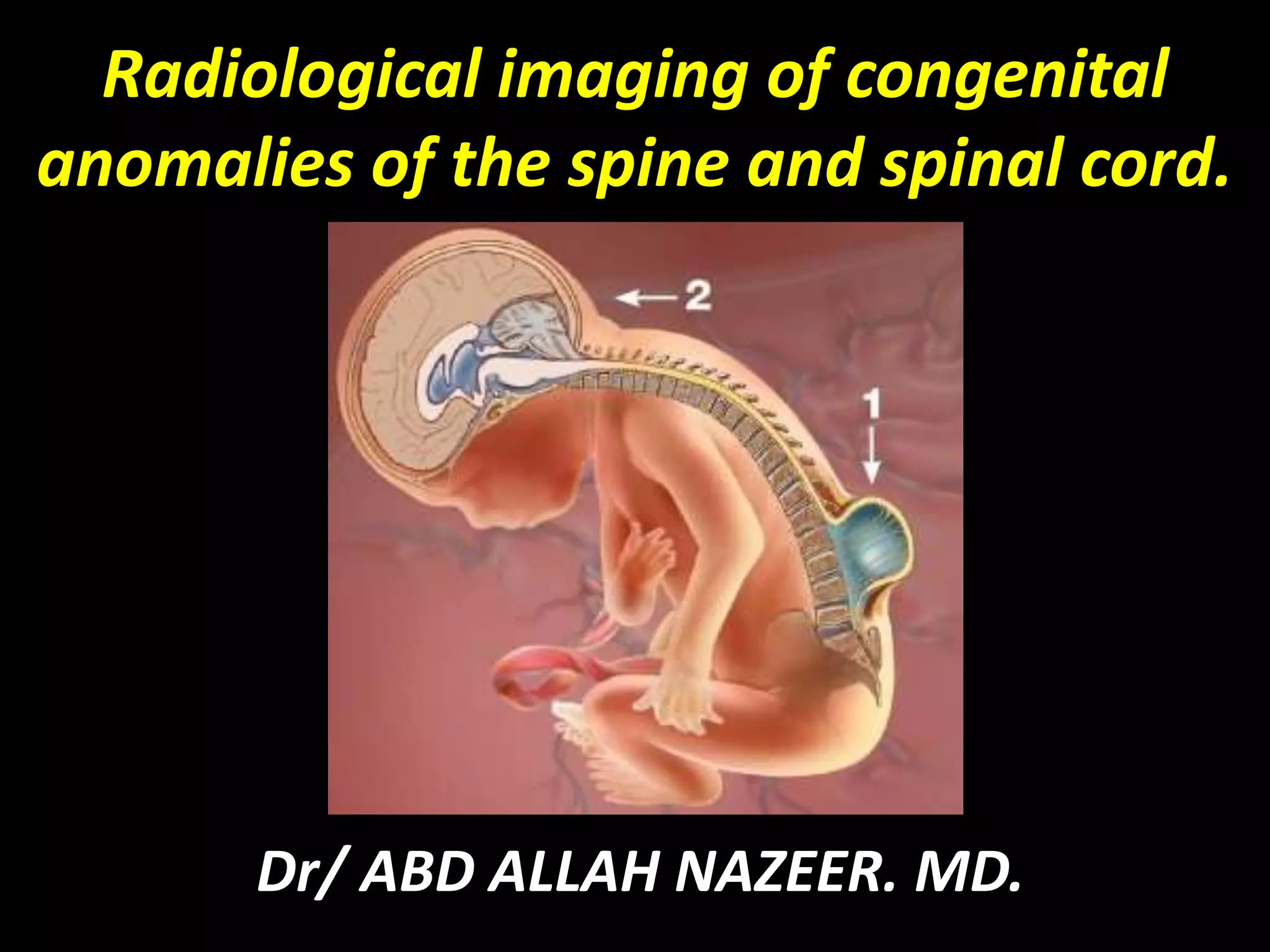 Presentation1.pptx, radiological imaging of congenital anomalies of the spine and spinal cord ...