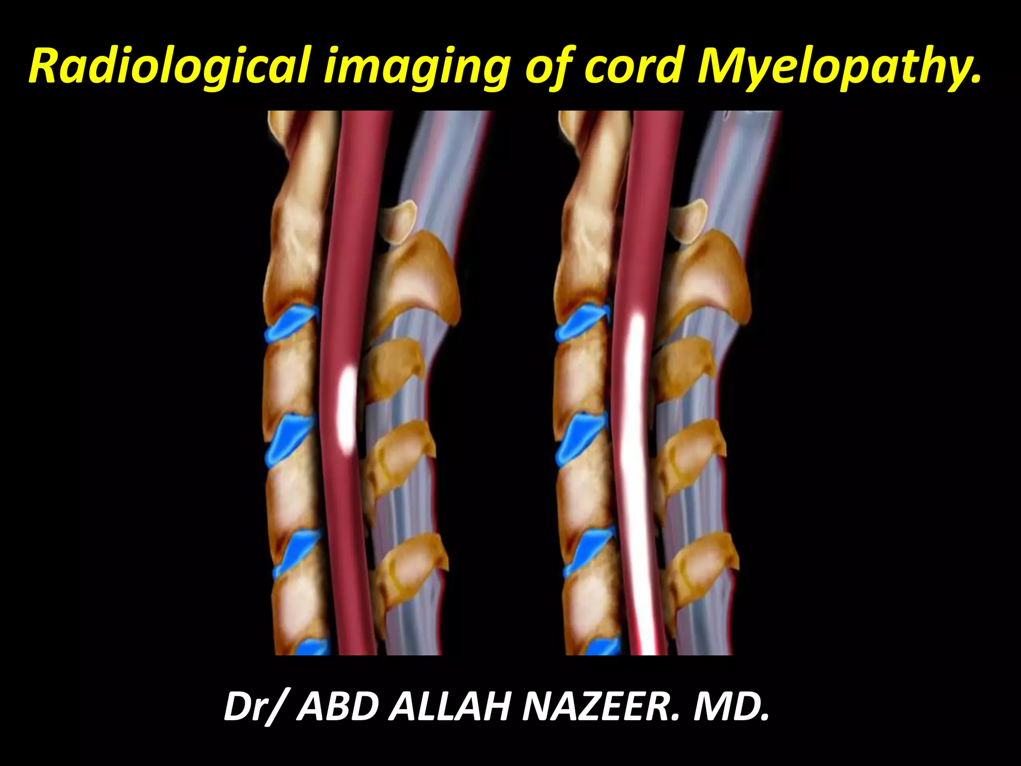 Presentation1.pptx,radiological imaging of cord myelopathy. | PPTX
