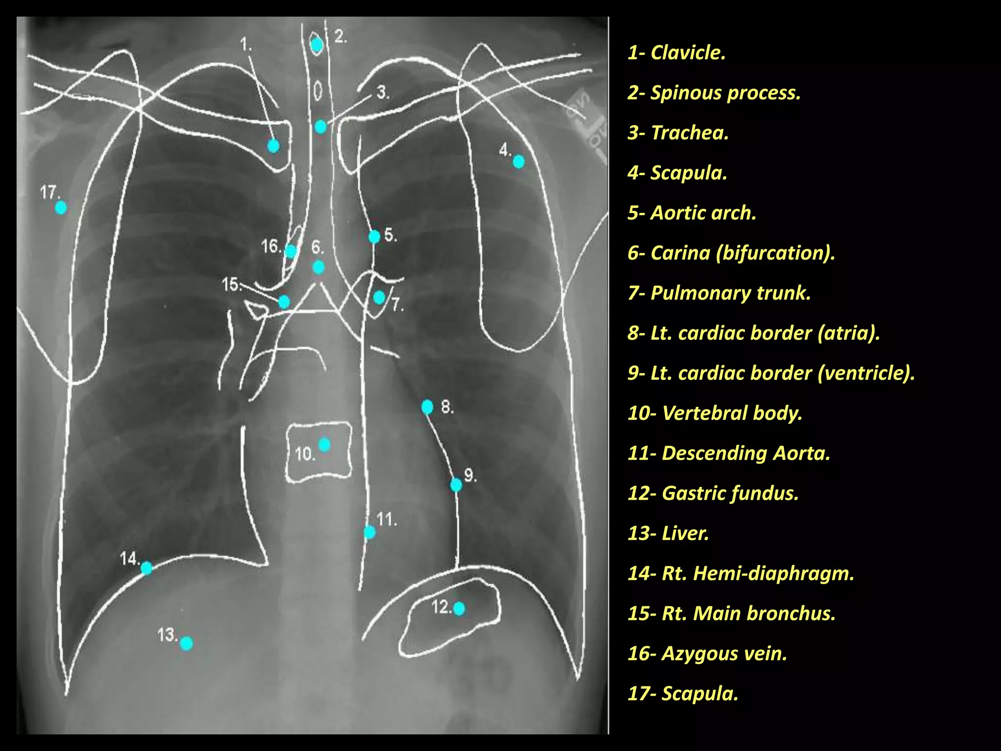 Presentation1.pptx, radiological anatomy of the chest. | PPTX
