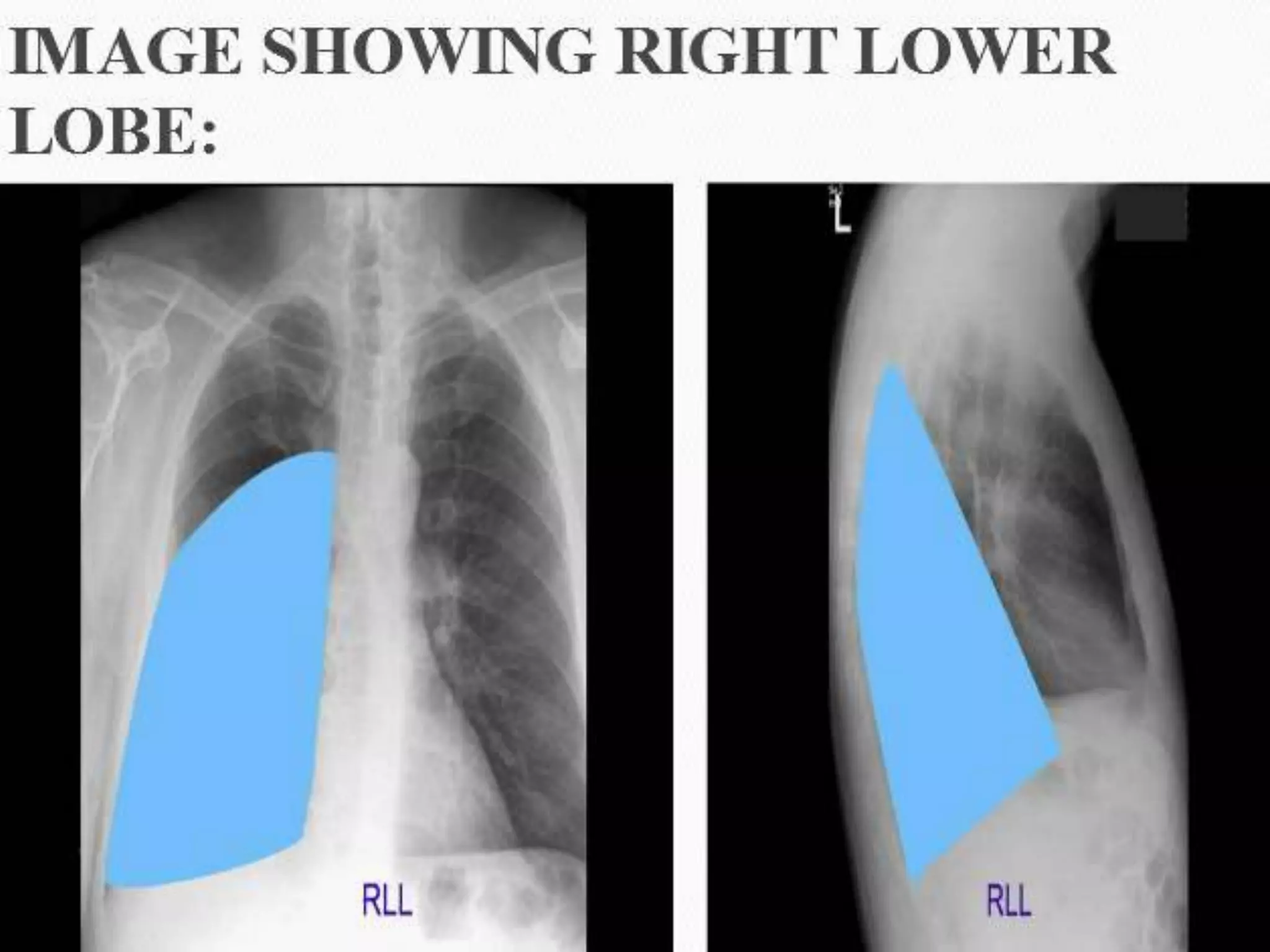 Presentation1.pptx, radiological anatomy of the chest. | PPTX