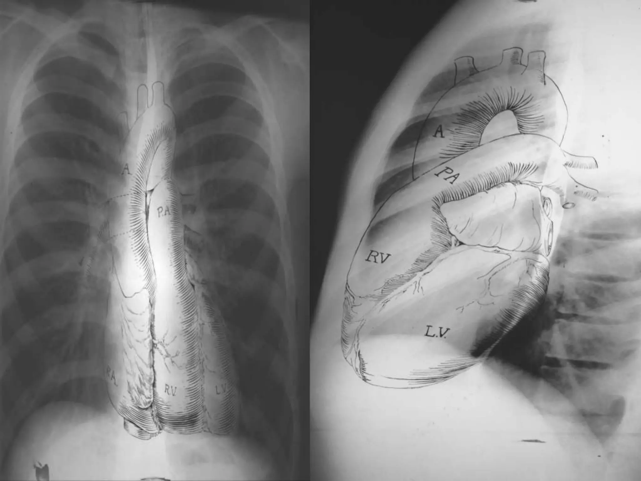 Presentation1.pptx, radiological anatomy of the chest. | PPTX