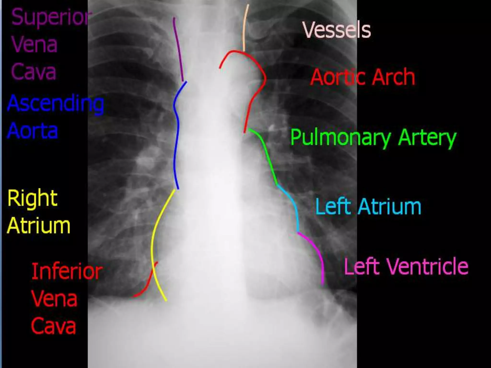 Presentation1.pptx, radiological anatomy of the chest. | PPTX