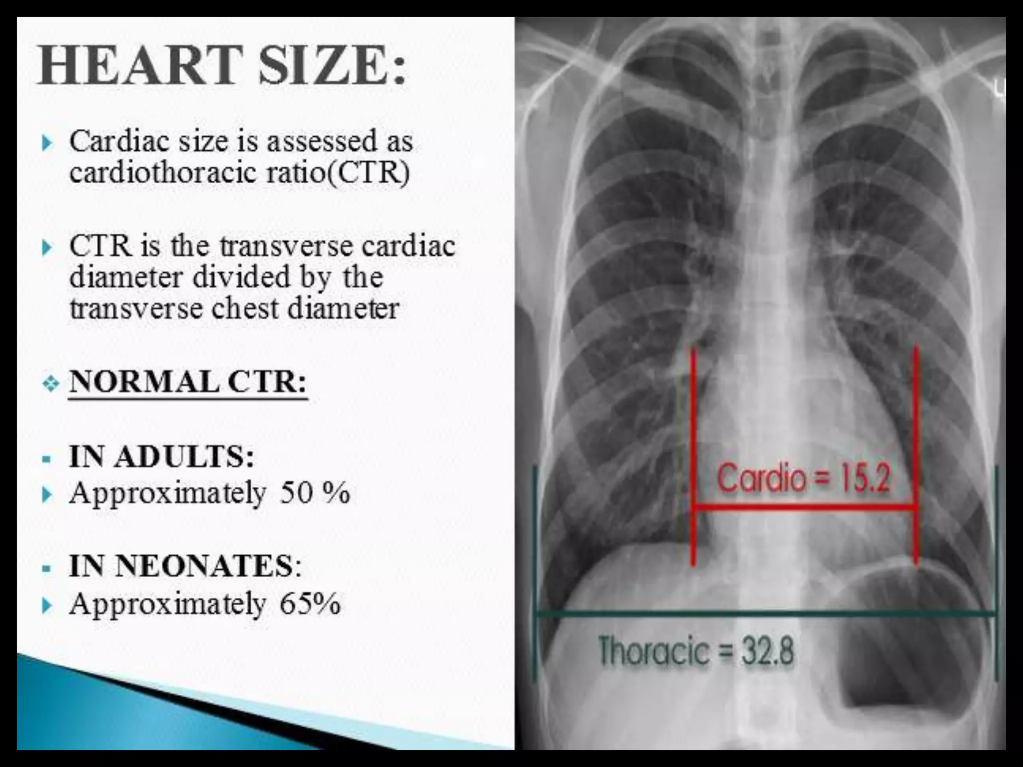 Presentation1.pptx, radiological anatomy of the chest. | PPTX