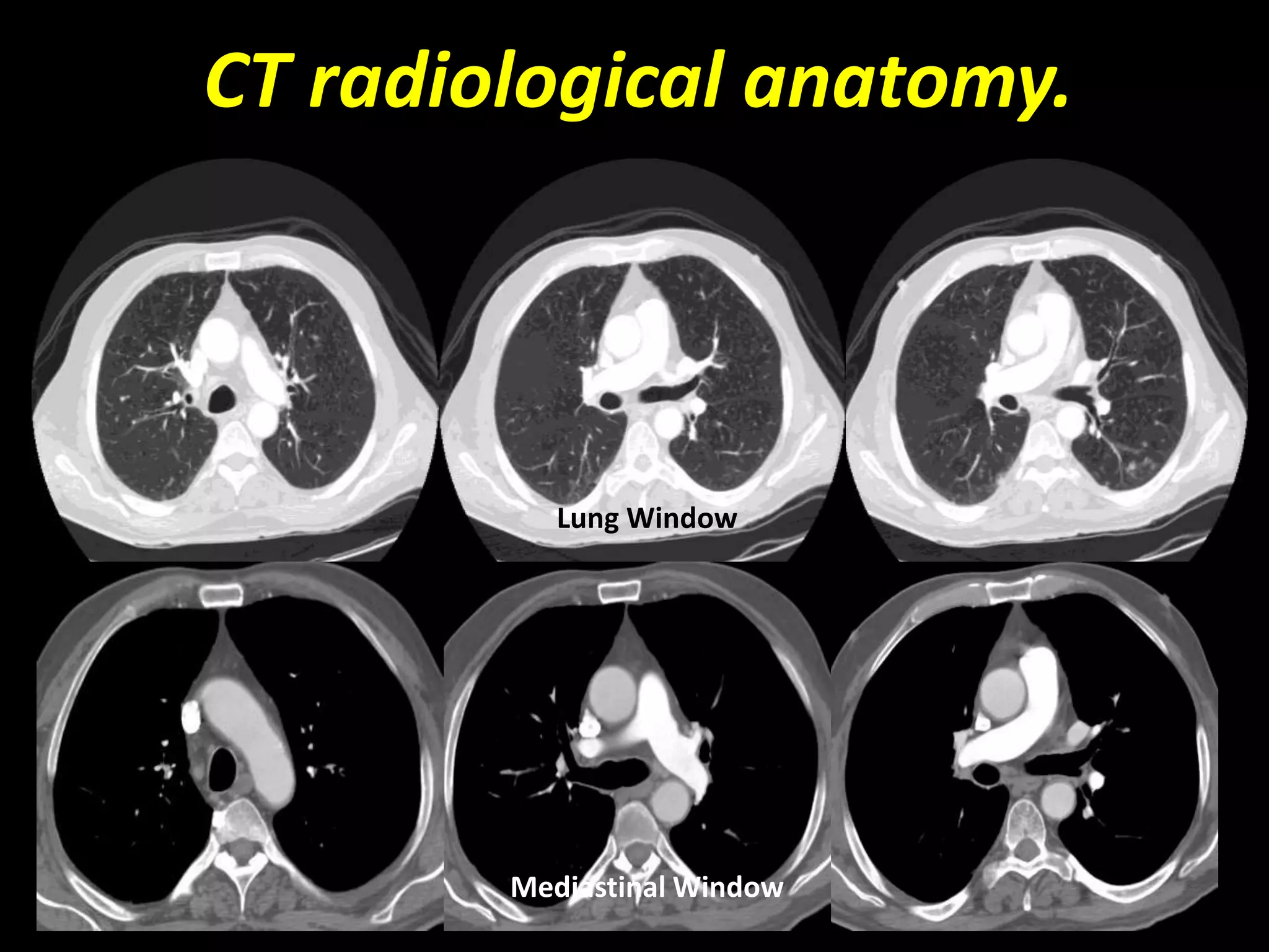 Presentation1.pptx, radiological anatomy of the chest. | PPTX