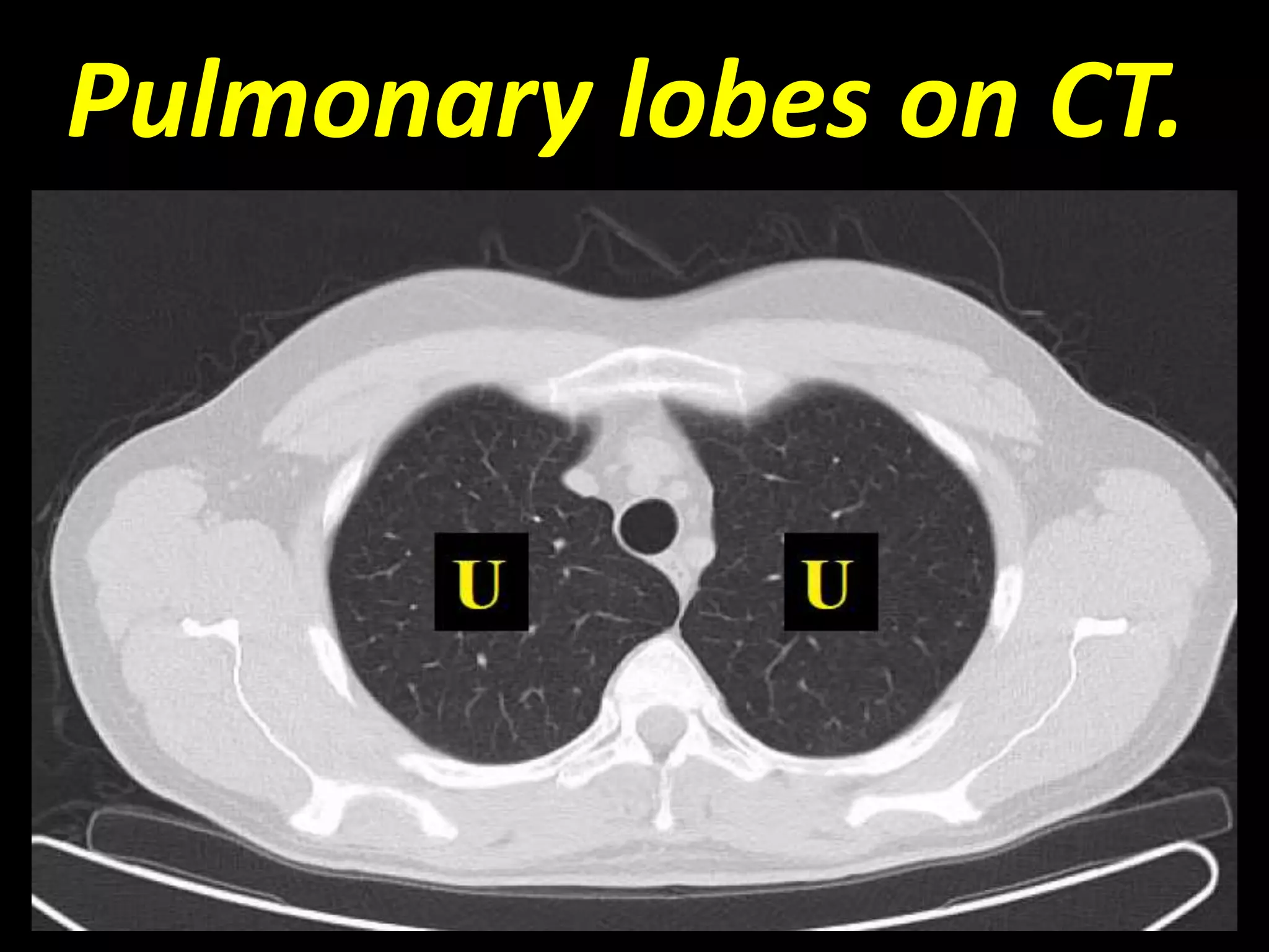 Presentation1.pptx, radiological anatomy of the chest. | PPTX