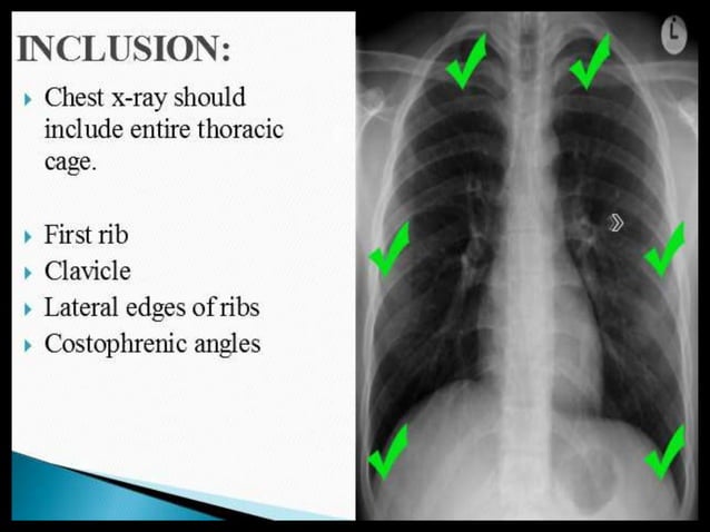 Presentation1.pptx, radiological anatomy of the chest. | PPTX