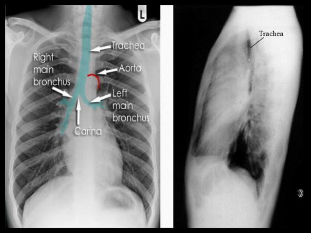 Presentation1.pptx, radiological anatomy of the chest. | PPTX